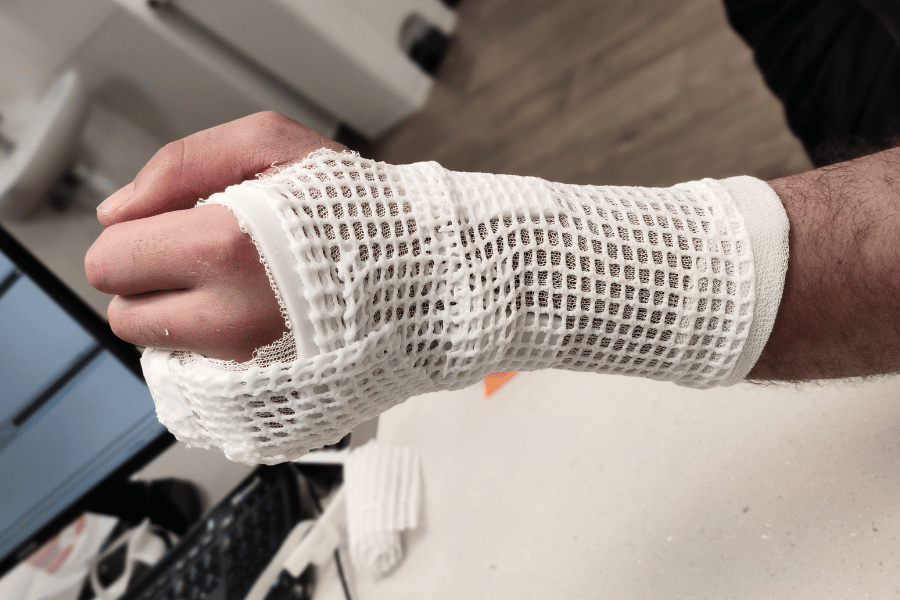 Férulas de mano a medida: La solución personalizada para la ...